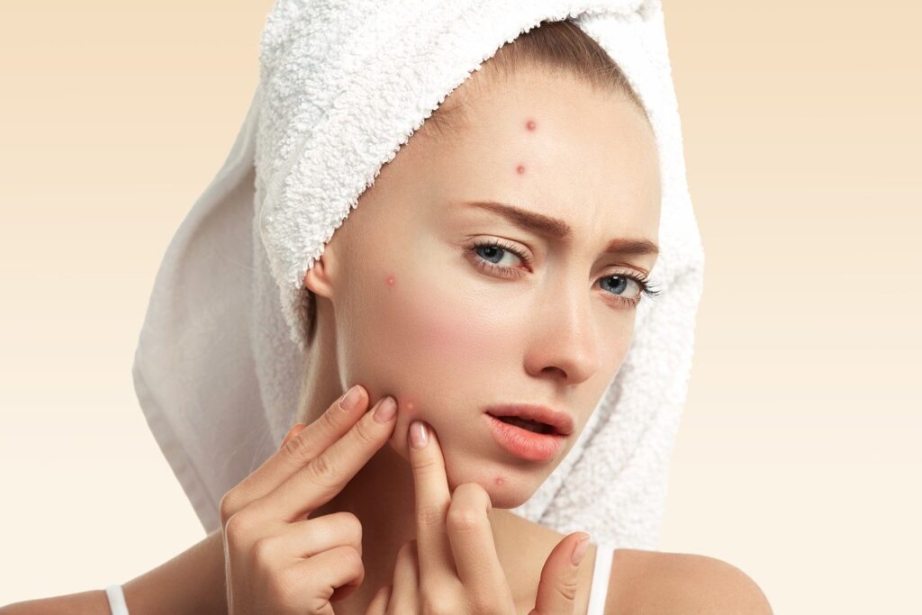 Ayurveda Treatment for Acne (Pimples) - swarayu